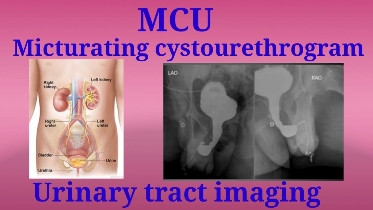 MCU Procedure # Micturating Cysto-urethrogram || Urinary tract imaging # By BL Kumawat