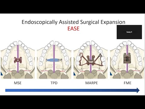 Nasomaxillary Expansion- A 30-year perspective