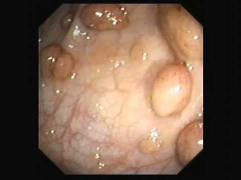 POLYPOSIS