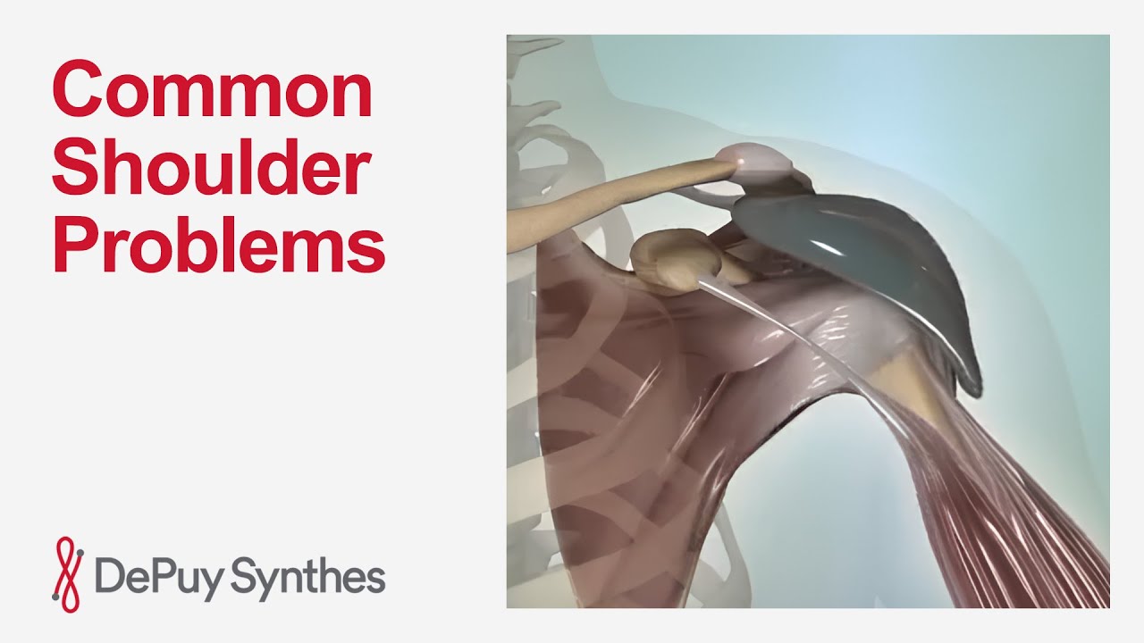 Shoulder Tendonitis, Bursitis & Impingement Syndrome Explained | DePuy Synthes