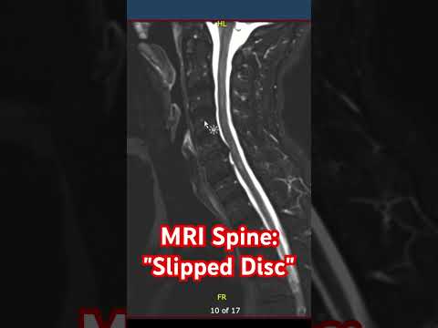 MS and a Slipped Disc? 😭