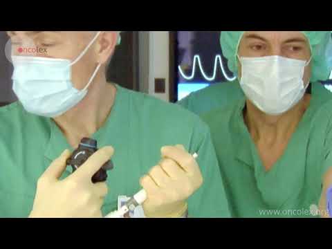 Endobronchial ultrasound bronchoscopy with needle biopsy