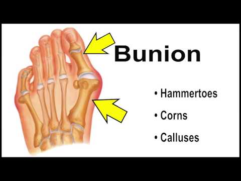 Dr, Scott Nelson, DPM - Bunions - Podiatrist in Garland, Firewheel and Plano, TX