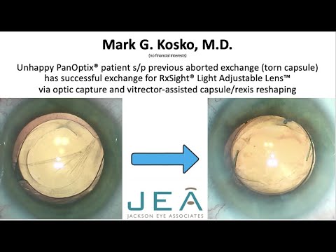 panoptix with broken bag exchange to Light Adjustable Lens