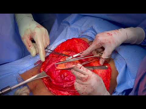 Clinical Challenges in Hernia Surgery: Open Preperitoneal Ventral Hernia Repair