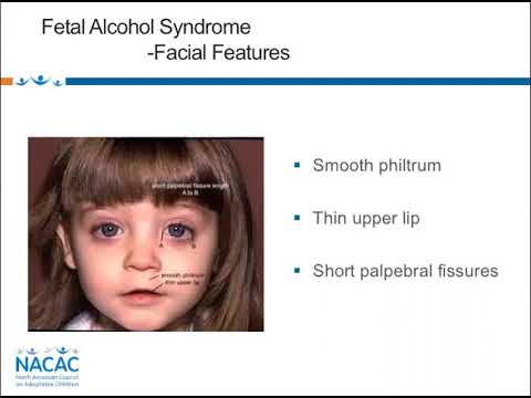 Fetal Alcohol Spectrum Disorders (audio description)