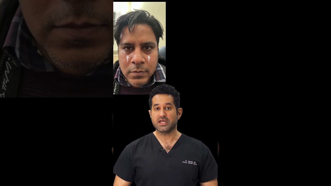 Dermal Fillers vs Dark Circles