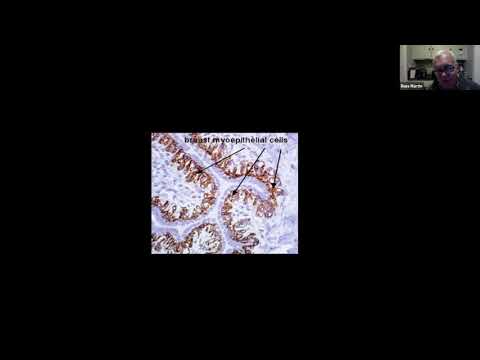 Benign Breast Disease