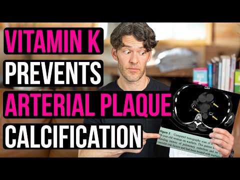 Vitamin K2 Prevents Arterial Calcification: Must Know-Science