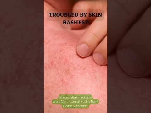 Skin Rash Natural Remedy! #youtubeshorts #shorts #viral #skincare #skinrashes #integrative_medicare
