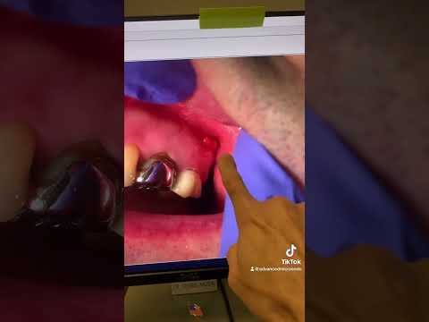 RCT of an abscessed tooth #15 through a crown in one visit.