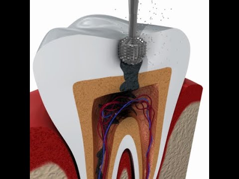 Root Canal Treatment (Endodontics)