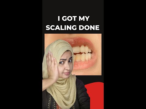 Is scaling or teeth cleaning bad? #scaling #dentalclinic