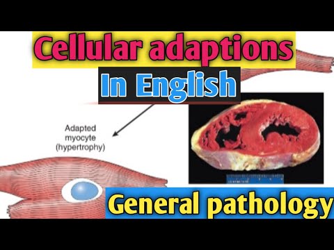 Cellular adaption in English language|Hypertrophy|Hyperplasia|Atrophy|Metaplasia|Dysplasi in English