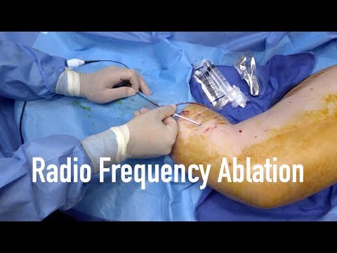 Radio frequency Ablation of Varicose Vein, how does it works