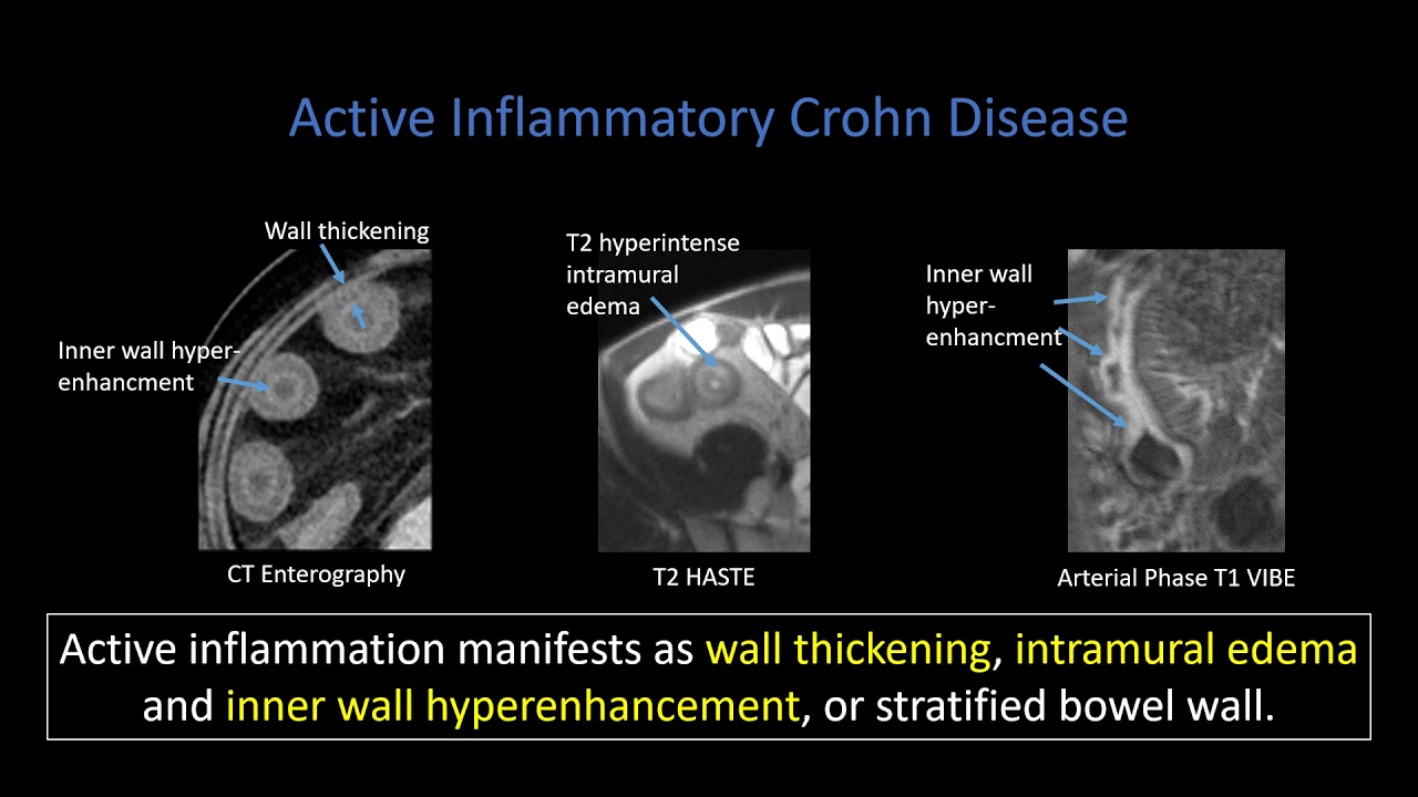 Crohn Disease: Part 1   Active Inflammation