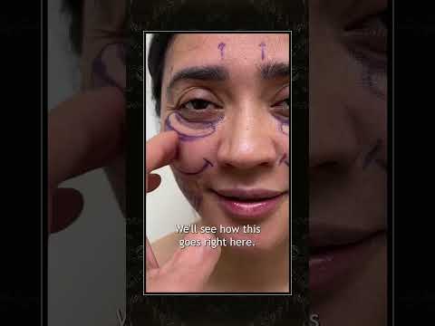 She Wants A Supermodel Version of Herself | The Ponytail Lift Day of Operation #facelift