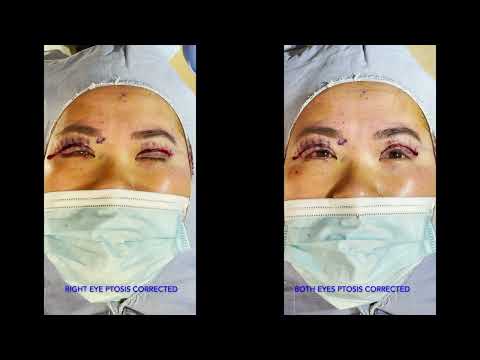 Ptosis Surgery | Droopy Eyelid Correction