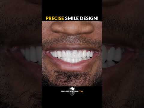 Amazing Precise Digital Smile Design by Brighter Image Lab #shorts