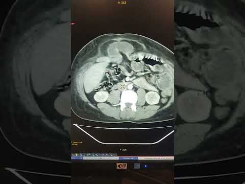 Abdominal hernia . #mri #anatomy #ct #hernias #shorts