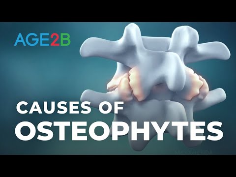 What Causes Osteophytes? | Prevalence | Degenerative Disc Disease