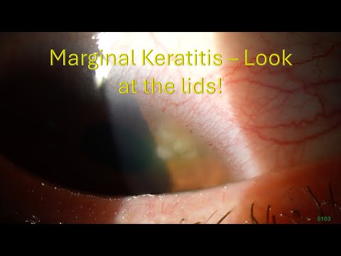 0103: Marginal Keratitis - Look at the lids!