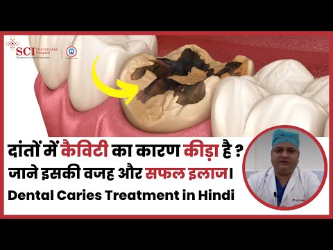 Dental Caries क्या होता है? | Tooth Cavity Stages in Hindi | Dr. Amit Parashar | SCI Hospital