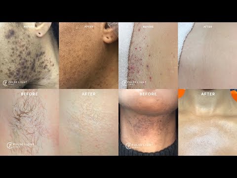 Lifetime Laser Hair Removal RESULTS in London