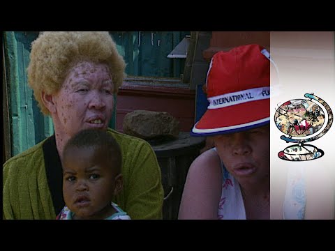 South African Albinos Are Being Shunned From Society