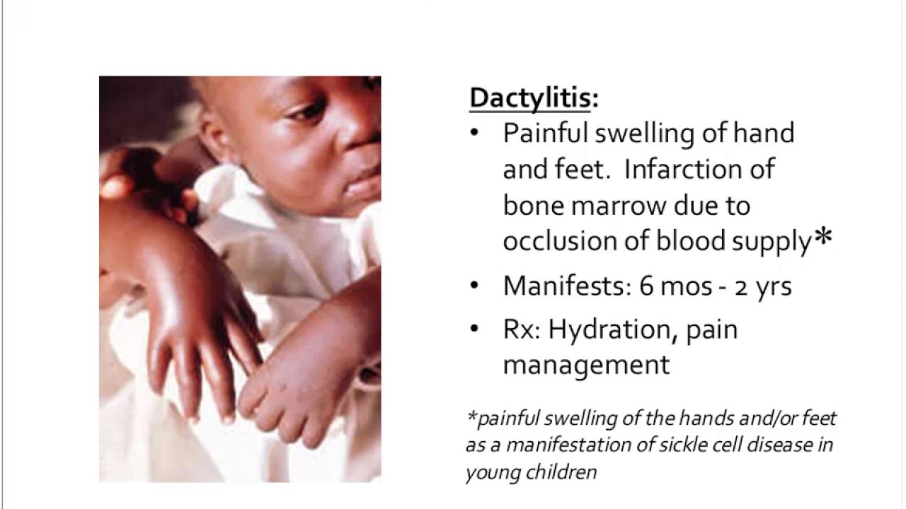 Blood Disorders (Hematology) | Children's National Hospital
