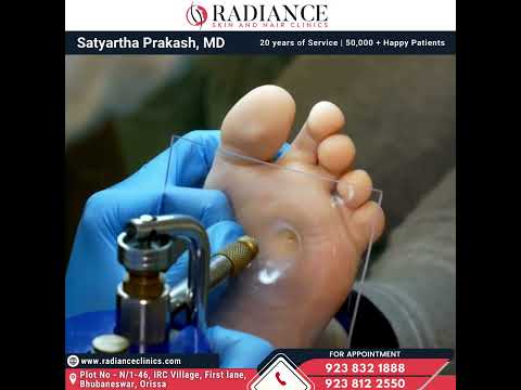 WART Removal at Radiance clinic#wartremoval #skincare #healthyskin #clearskinjourney #Dermatology