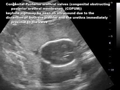 CASE 545 Congenital Posterior urethral valves PUV keyhole sign