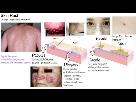 Understanding Rash in 3 minutes. Skin Rash types and causes.