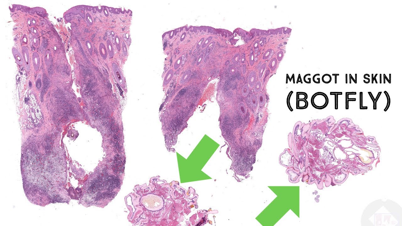 Botfly (fly larva/maggot in skin) dermatobia hominis tropical parasite myiasis pathology