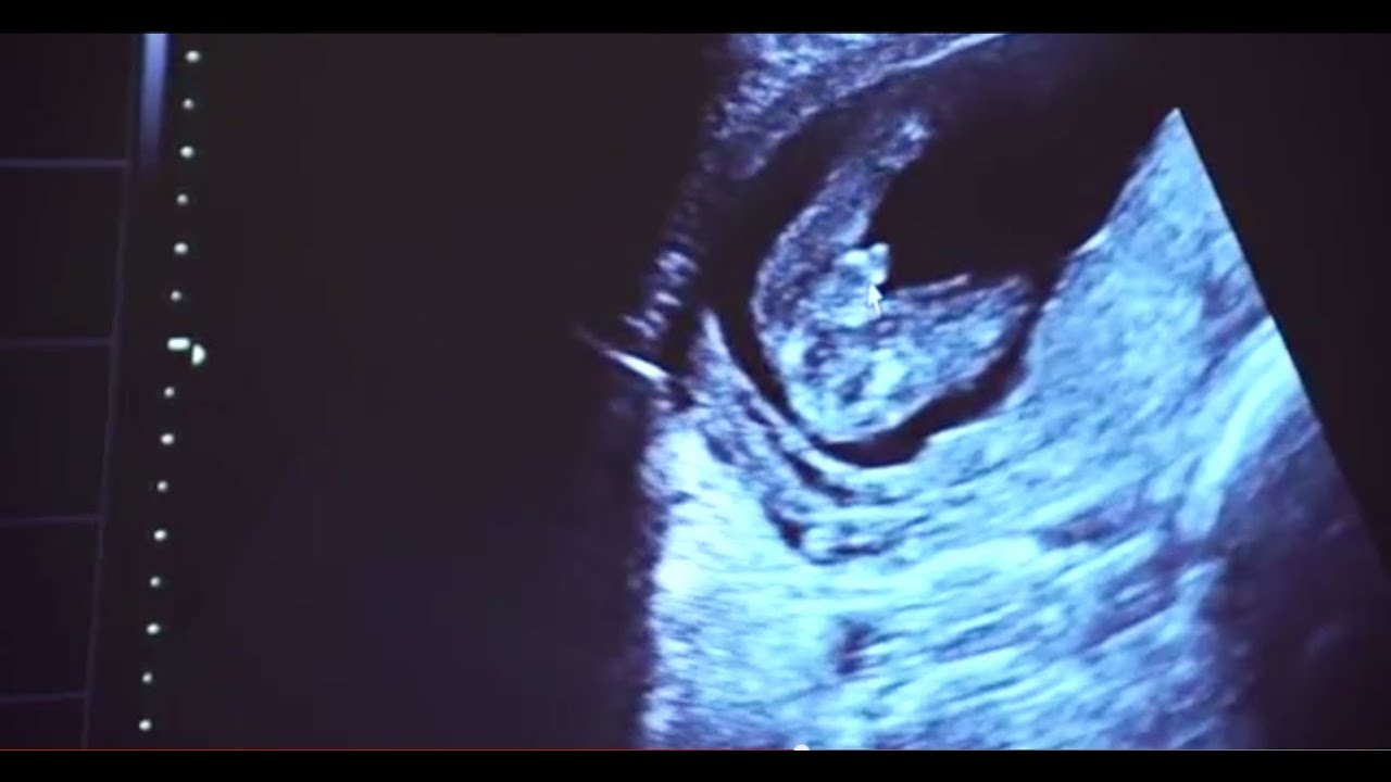 Sexing or Gender Scan (17 Weeks - 23 Weeks)