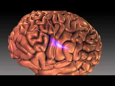 Epilepsy - (Cortical Dysplasia)