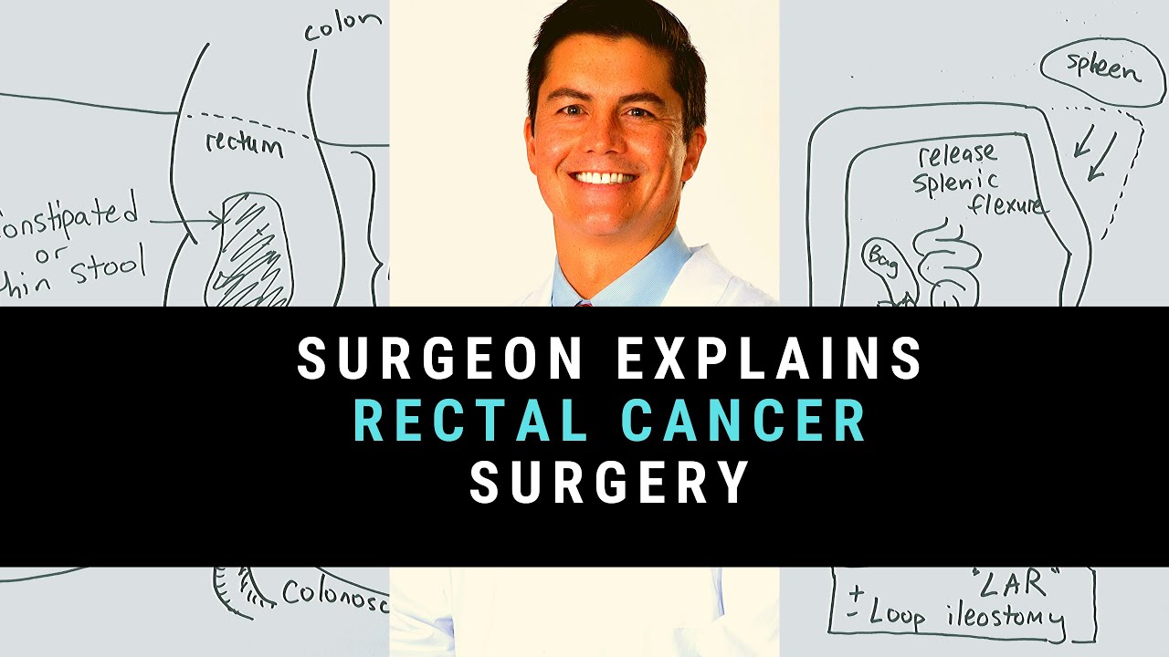 Surgeon Explains Rectal Cancer Surgery
