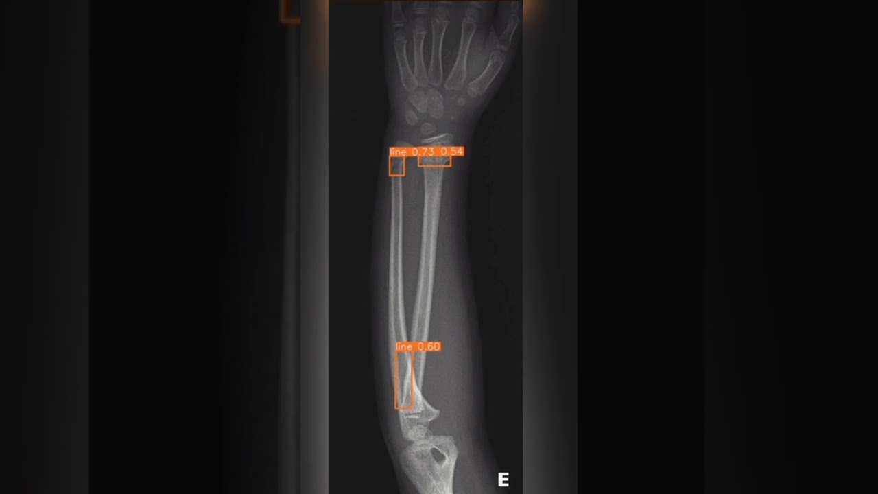 #xray  #bone  #fracture  #detection  #yolov8 #shorts #trending