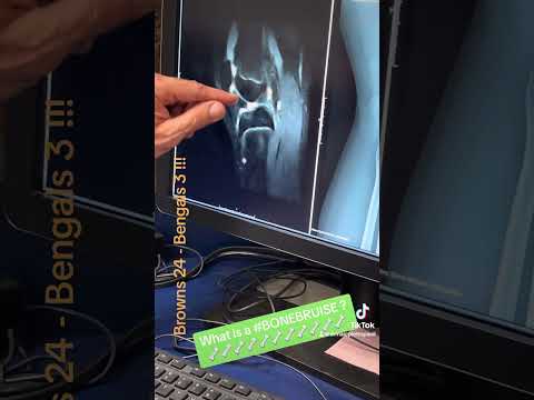 What is a bone bruise?
