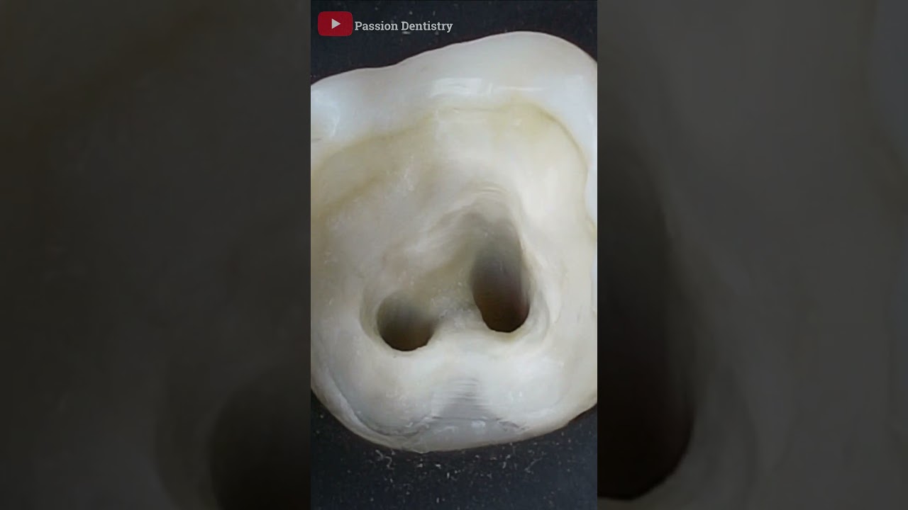 Accessing The Root Canals #teeths