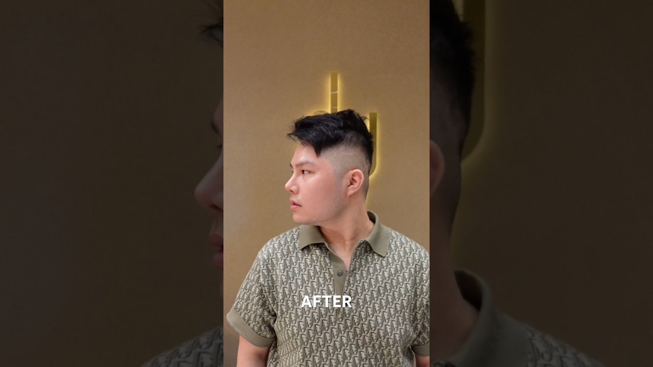 Male rhinoplasty and Alarplasty using his own rib cartilage and DCF.