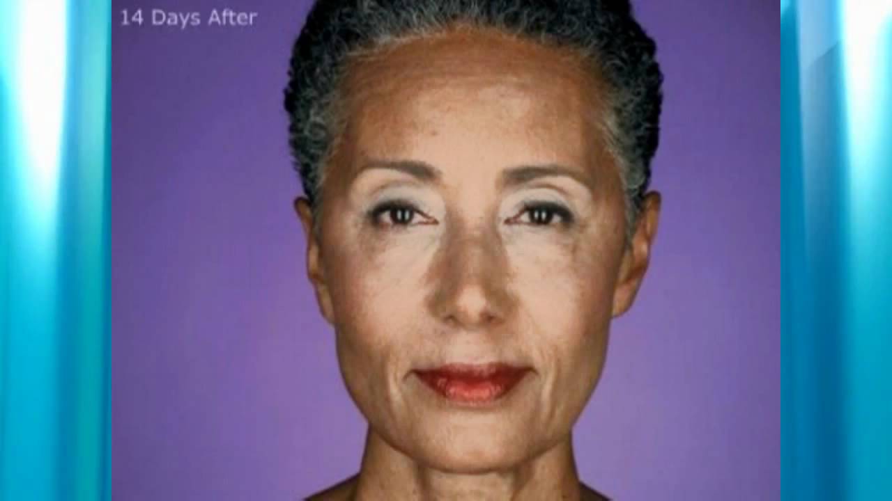 BOTOX Before and After Gallery 1