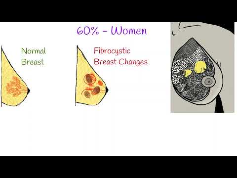 Fibrocystic breast- Causes, Symptoms and Treatment. Fibrocystic Breast Disease;