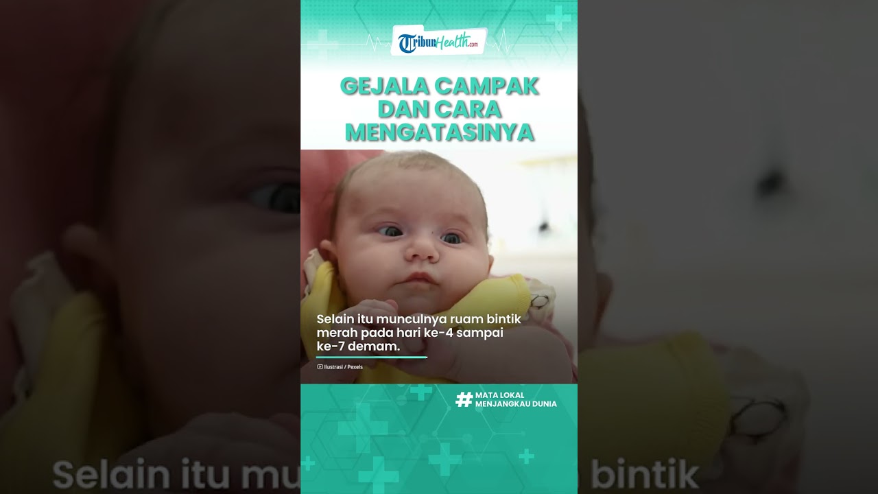 Munculnya Ruam pada Anak Bisa Jadi Tanda Penyakit Campak, Kenali Gejala ...