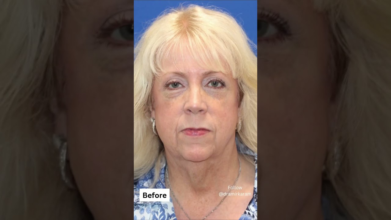 Incredible Facelift Took 20 Years Off!