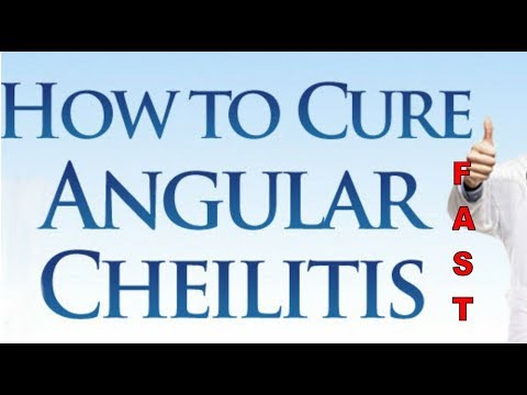Angular Cheilitis Options and Searches