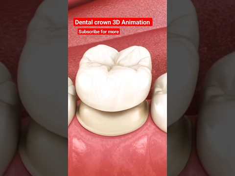 dental crown 3D Animation #shorts #viral