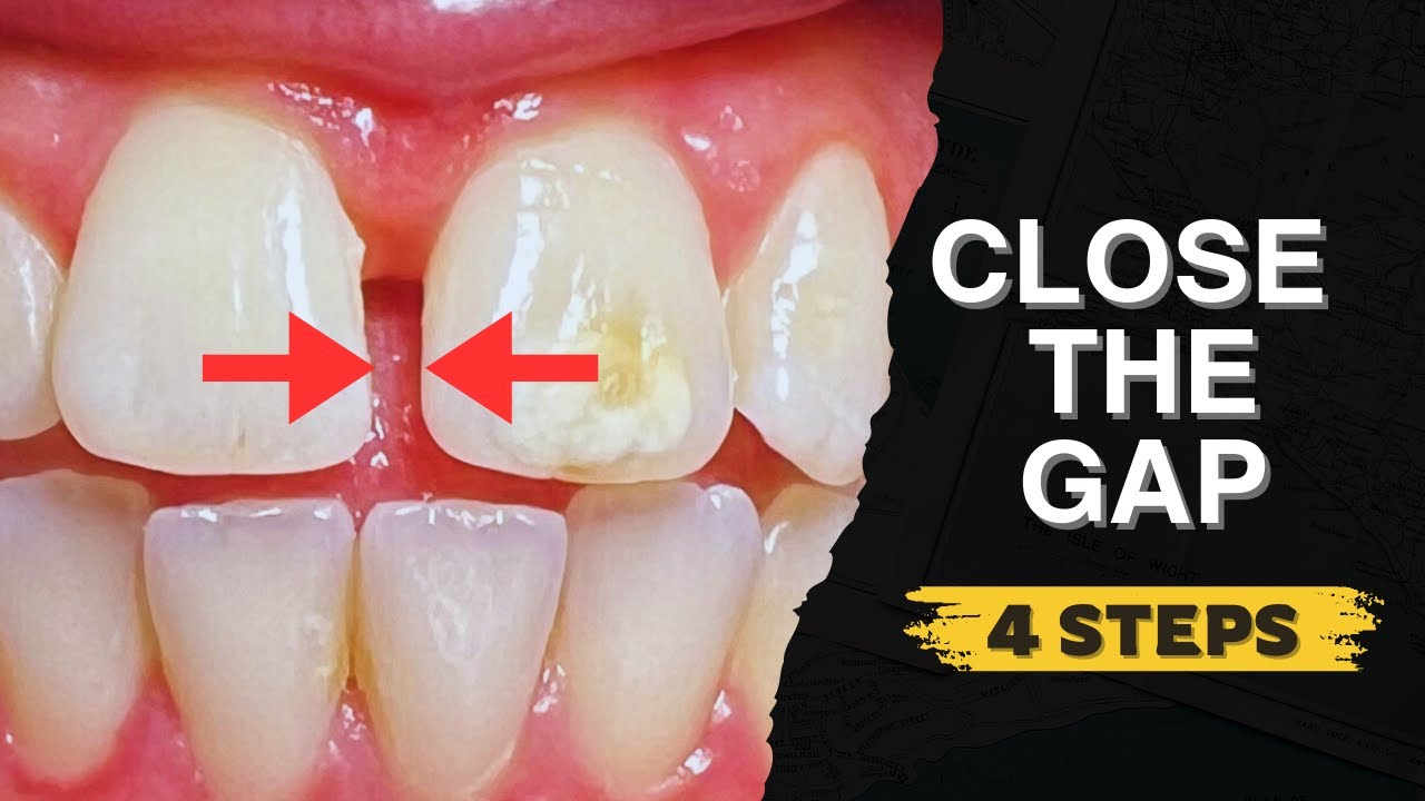 How to Close a Front Tooth Gap (Diastema) | 4 Steps You MUST Know
