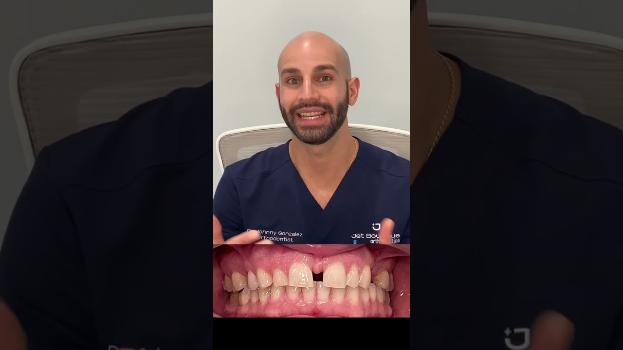 How We Close A Large Front Gap With Invisalign