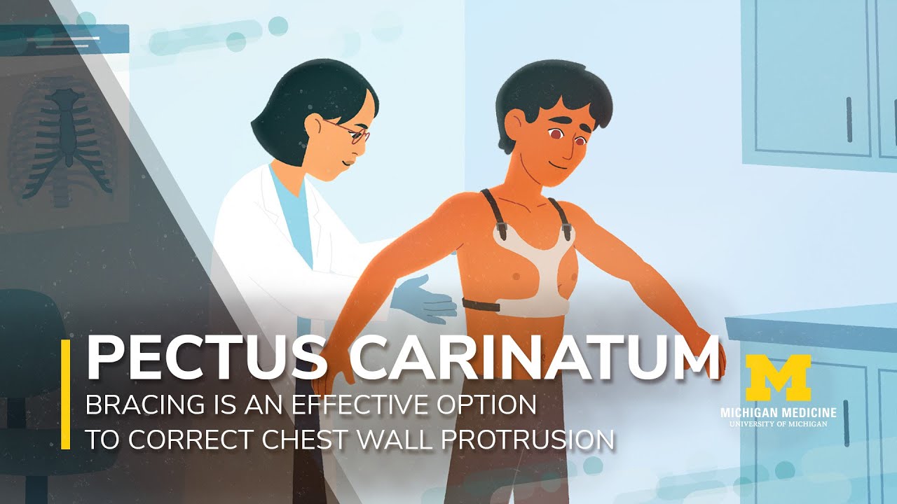 How Michigan Medicine Treats Pectus Carinatum